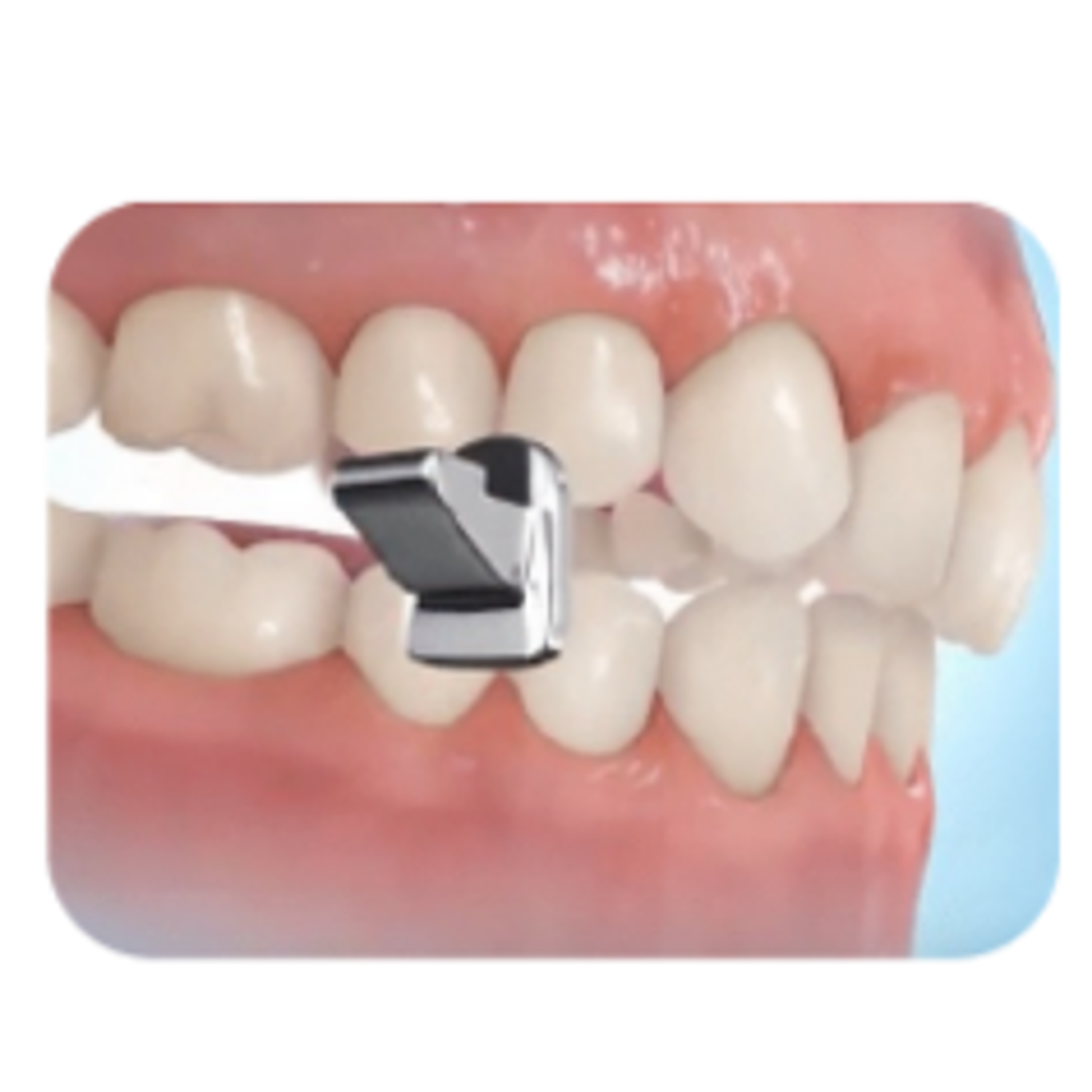 Mua Nút Dán Nâng Khớp Cắn (Bite Turbo) ️ Giá Rẻ Nhất【FREESHIP】