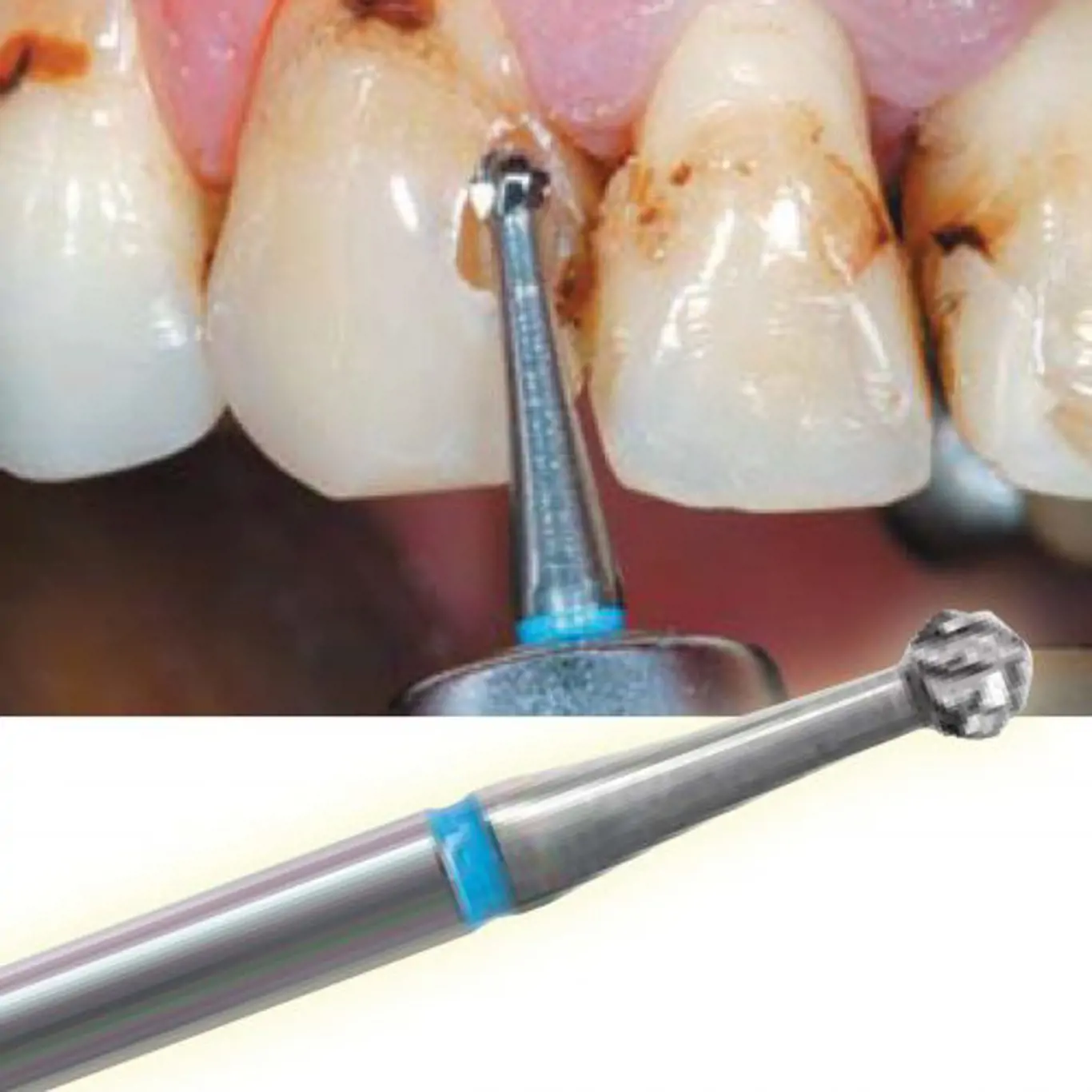 Mua Bộ Mũi Khoan Tungsten - Tugsten Carbide Burs ️ Giá Rẻ Nhất【FREESHIP】