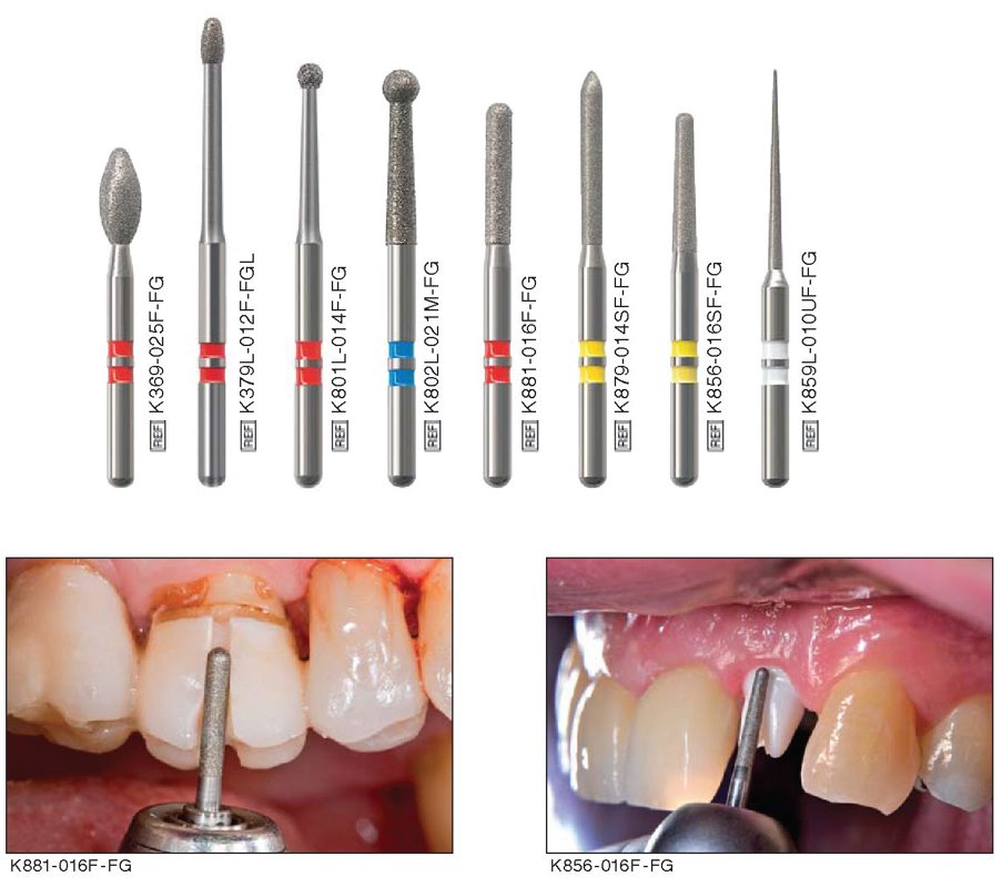 Mua Mũi Cắt Zirconia - Trimming Of Sintered Zirconia ️ Giá Rẻ Nhất ...
