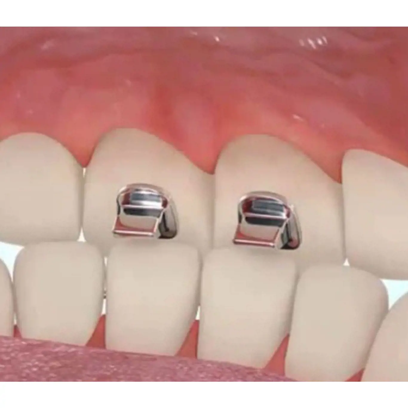 Mua Nút Chặn Khớp Bite Turbos ️ Giá Rẻ Nhất【FREESHIP】