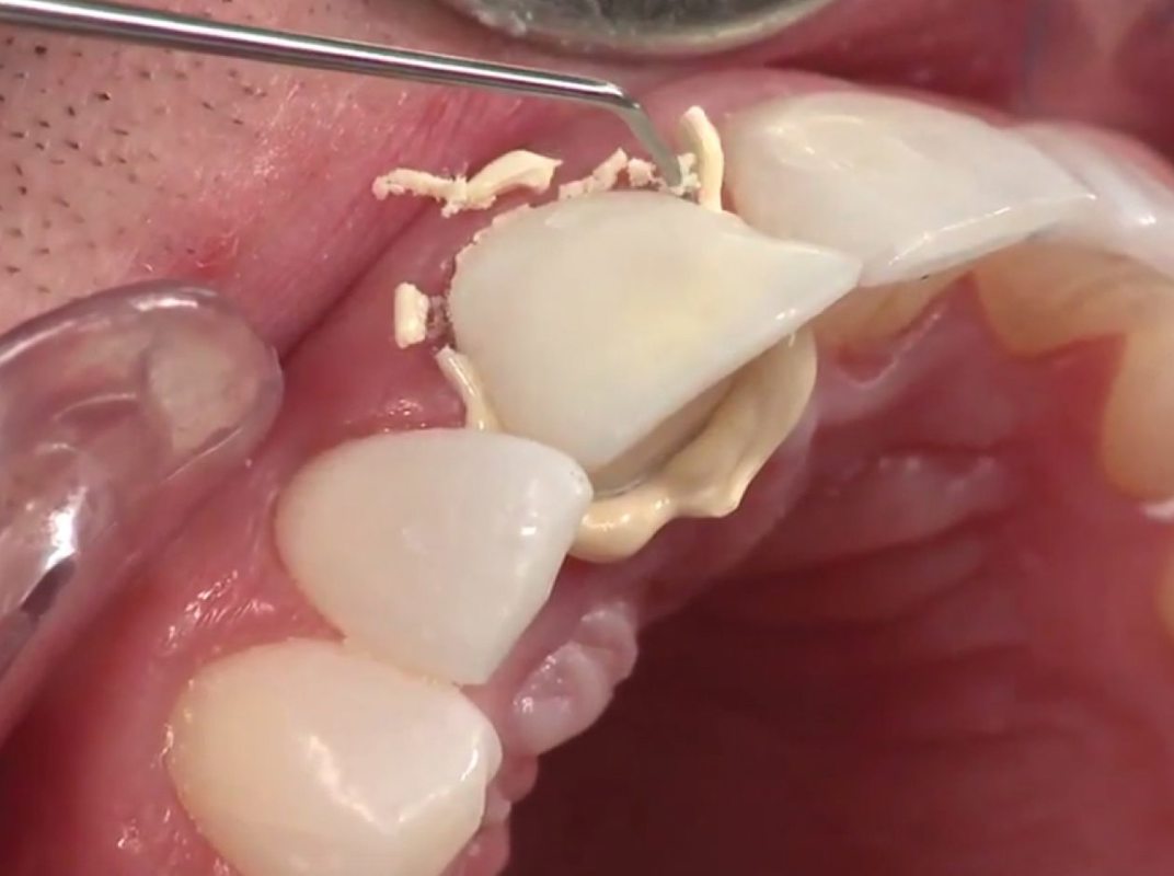 Mua Xi Măng Tạm - Ultratemp Tempo Cement & Ultratemp Rez Tempo Cement ️ ...