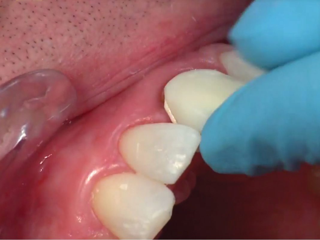 Mua Xi Măng Tạm - Ultratemp Tempo Cement & Ultratemp Rez Tempo Cement ️ ...