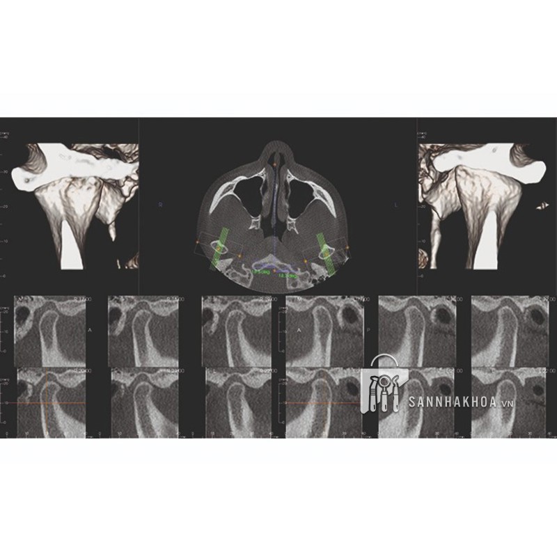 Mua Máy Chụp Ct Kavo Op 3D Vision Kavo Dental Technology ️ VAT đầy đủ