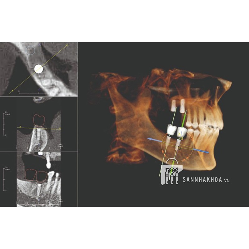 Mua Máy Chụp Ct Kavo Op 3D Vision Kavo Dental Technology ️ VAT đầy đủ