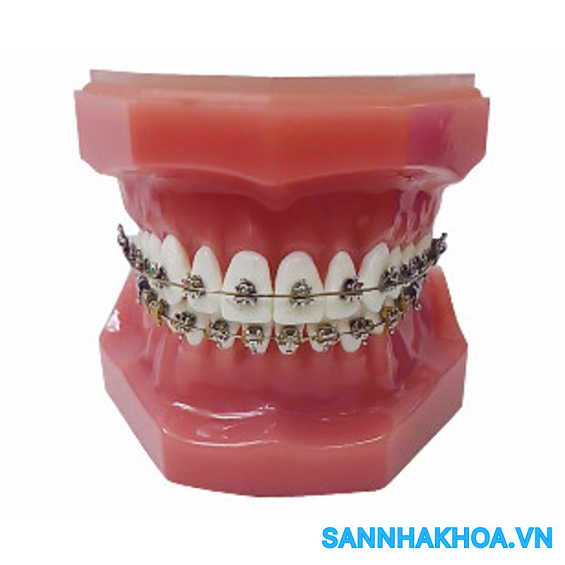 Mua Giá Khớp Chỉnh Nha Có Mắc Cài Delta Force Brackets ️ VAT đầy đủ