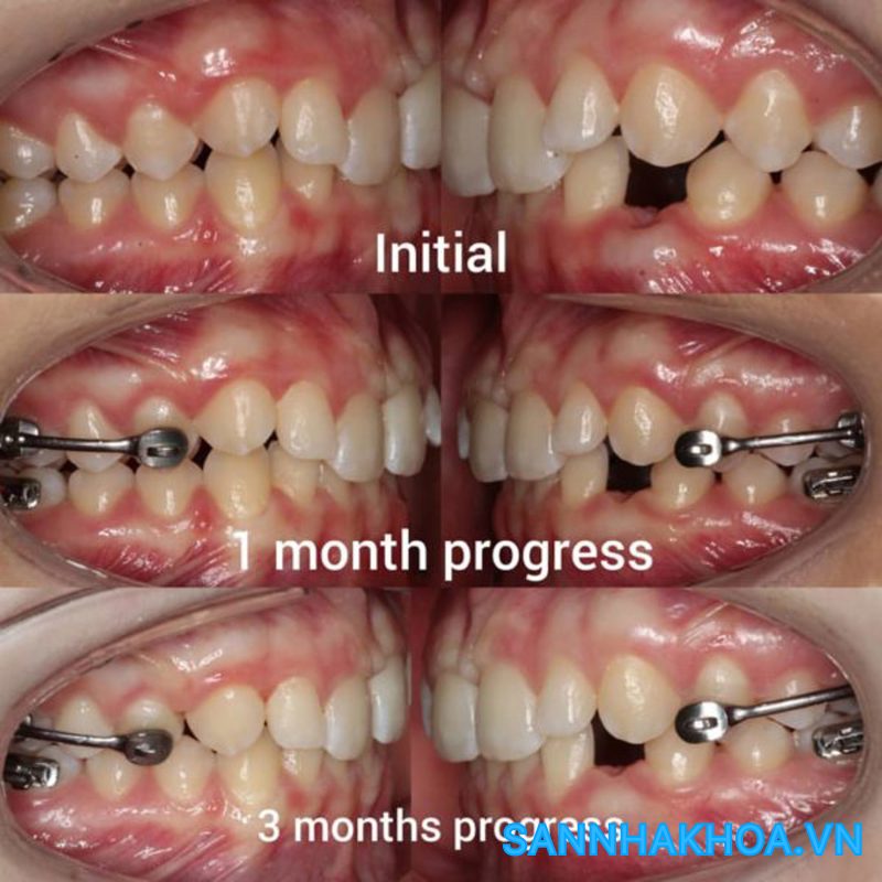 Mua Khí Cụ Điều Trị Sai Khớp Cắn Loại 2 Carriere Motion Kim Loại Trái ...